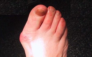 Exista o operatie cu laser pentru monturi (hallux valgus)? | MedLife