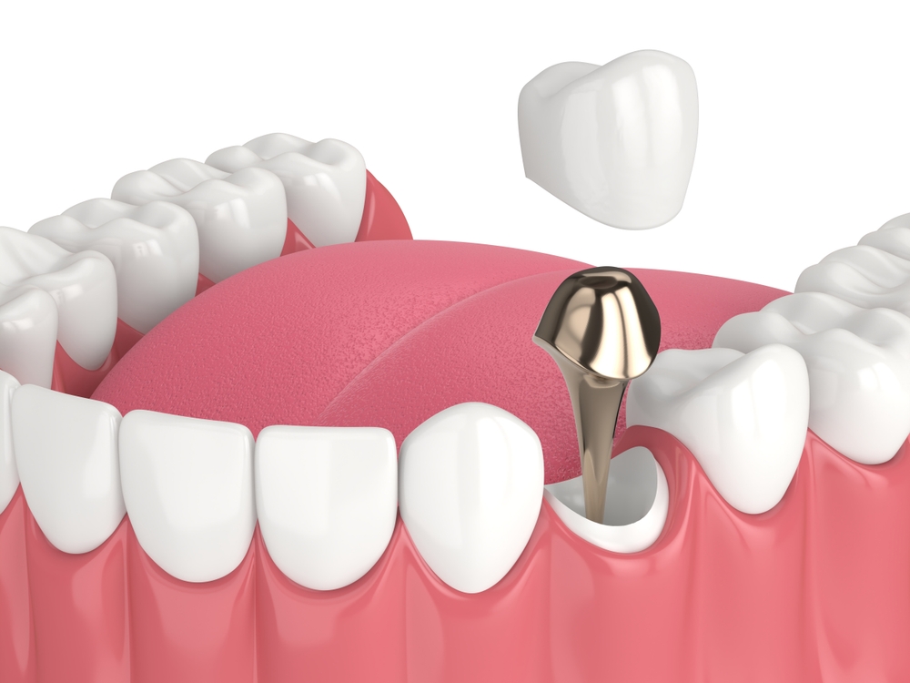 Pivot dentar: tipuri, cand e recomandat, contraindicatii