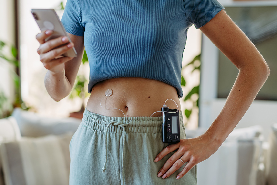 Pompa insulina: ce este si cum functioneaza | MedLife