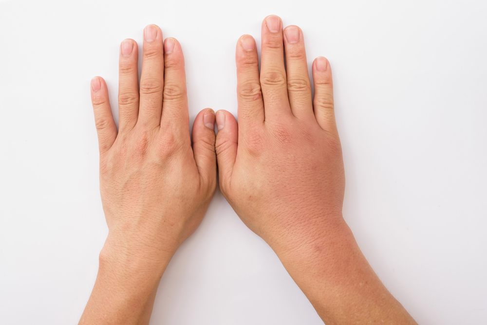 Maini si degete umflate: care sunt principalele cauze | MedLife