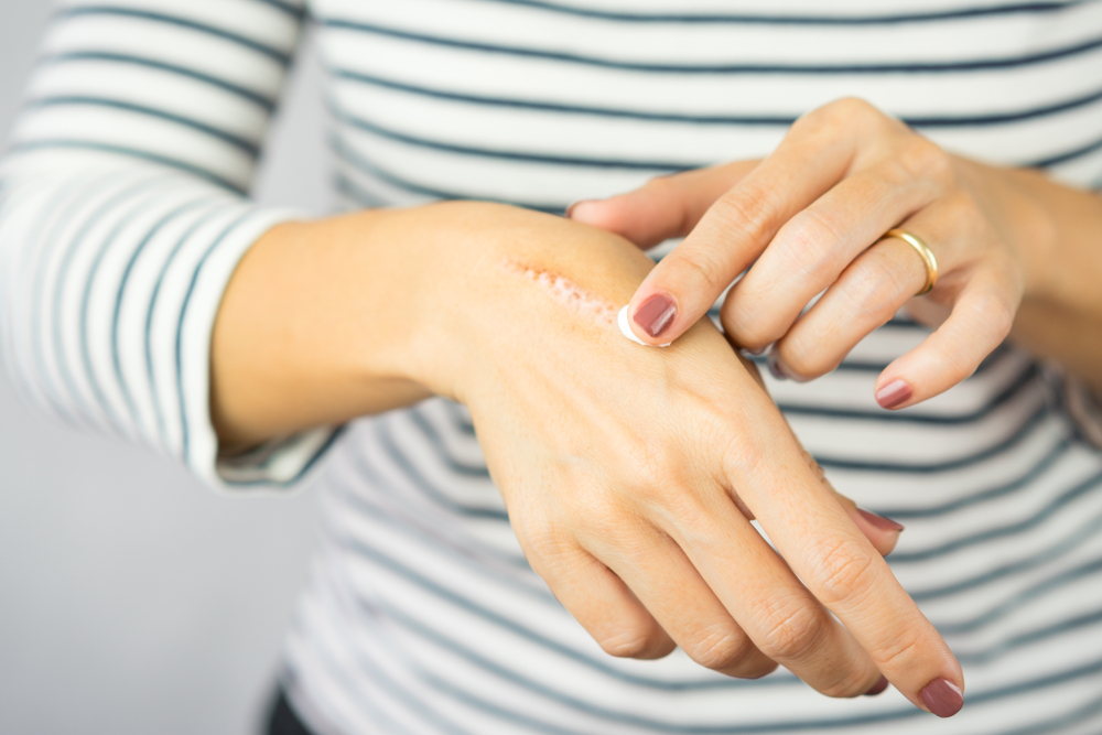 Arsuri termice: ce trebuie să știi? | MedLife