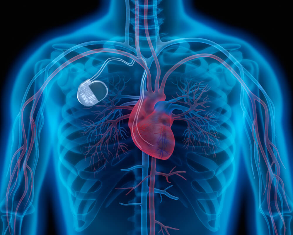 Implantarea stimulatorului cardiac: Indicații, procedură, întrebări ...