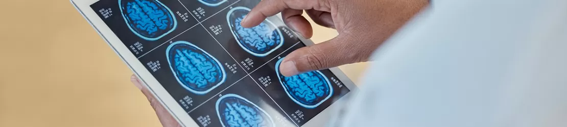 Lobotomie: ce este si in ce consta aceasta procedura | MedLife