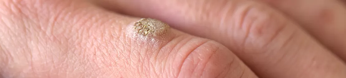 Negi (Veruci): Cauze, simptome, diagnosticare, tratament | MedLife